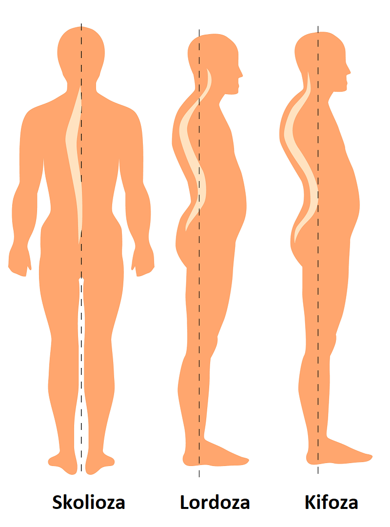 Gorset ortopedyczny do leczenia skolioz i kifoz - stabilizacja odchyleń bocznych i obrotowych ...