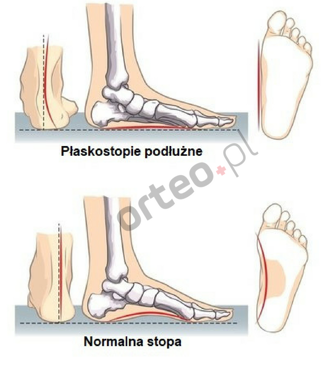 STOP ... problemom stóp - Blog Orteo.pl